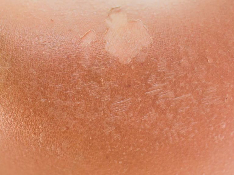 Masalah Kulit yang Biasa Dihidapi oleh Orang Tua - Homage Malaysia